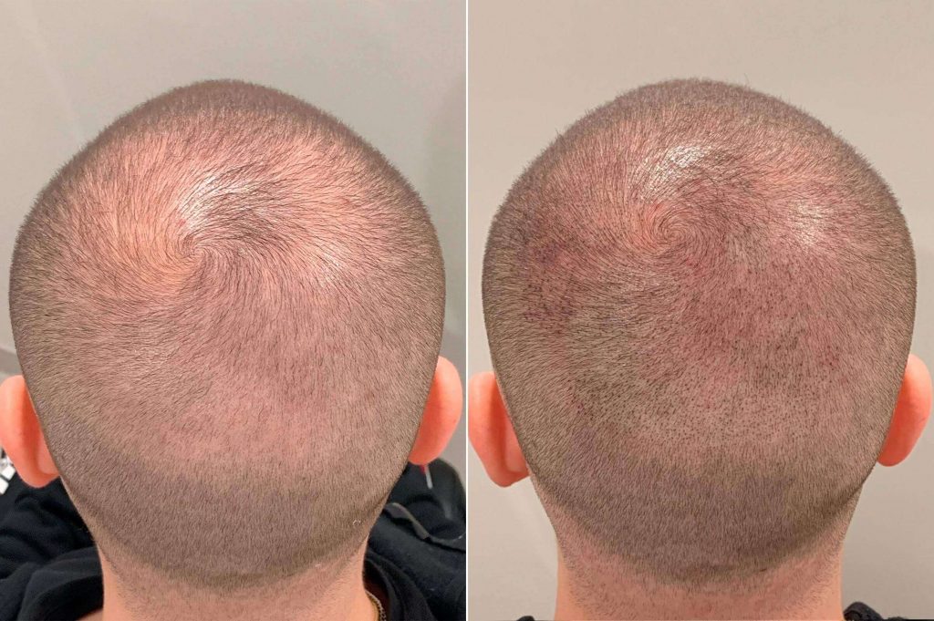 Scalp Micropigmentation – Does it Look Natural? | Hair N Images